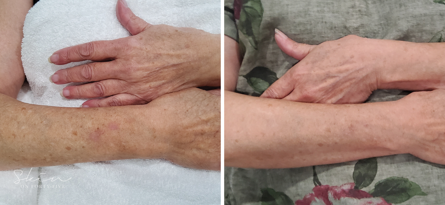 PIGMENT + REDNESS MANAGEMENT – Skin On Forty Five