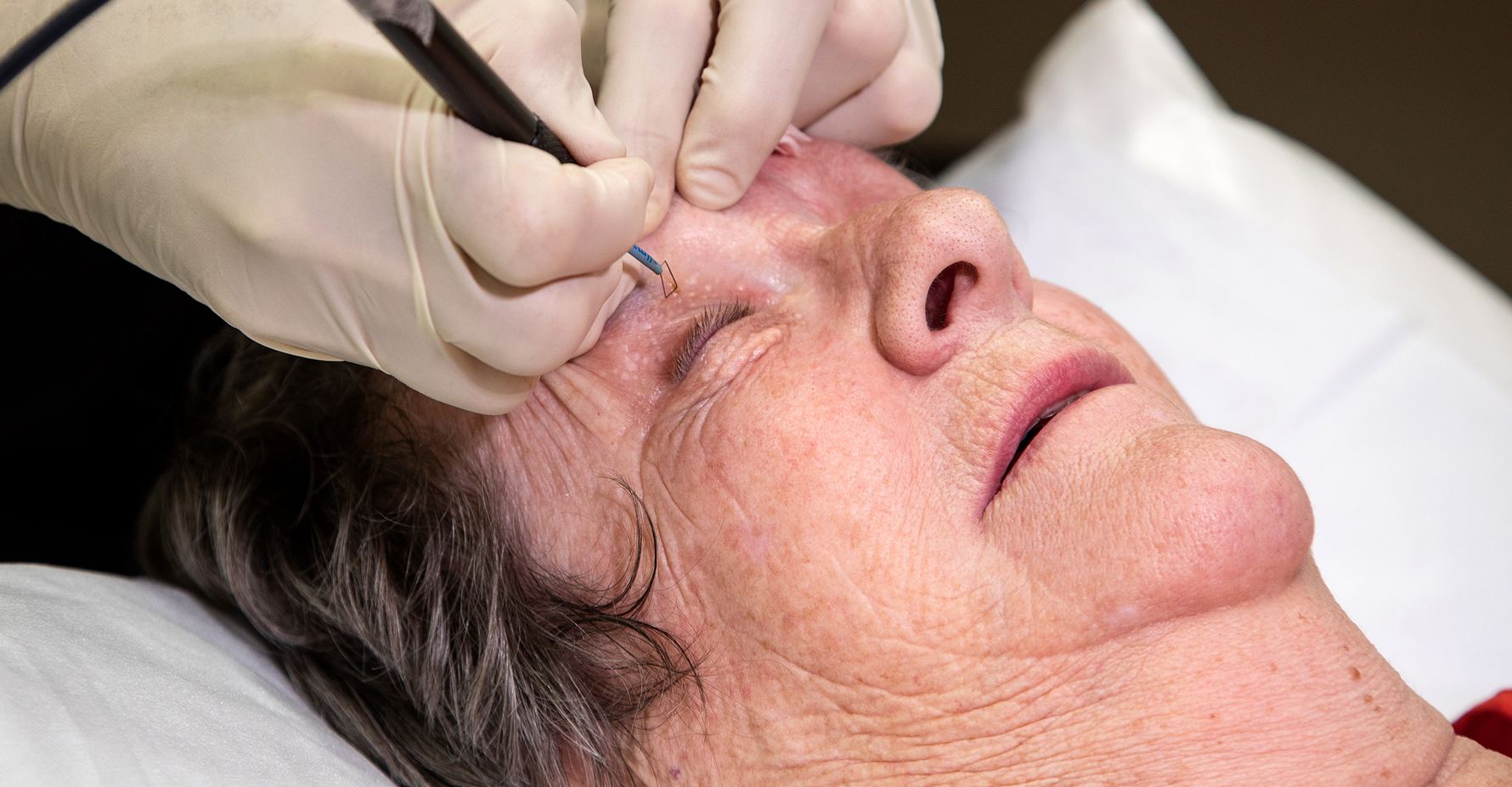 SURGITRON COSMETIC MOLE REMOVAL – Skin On Forty Five