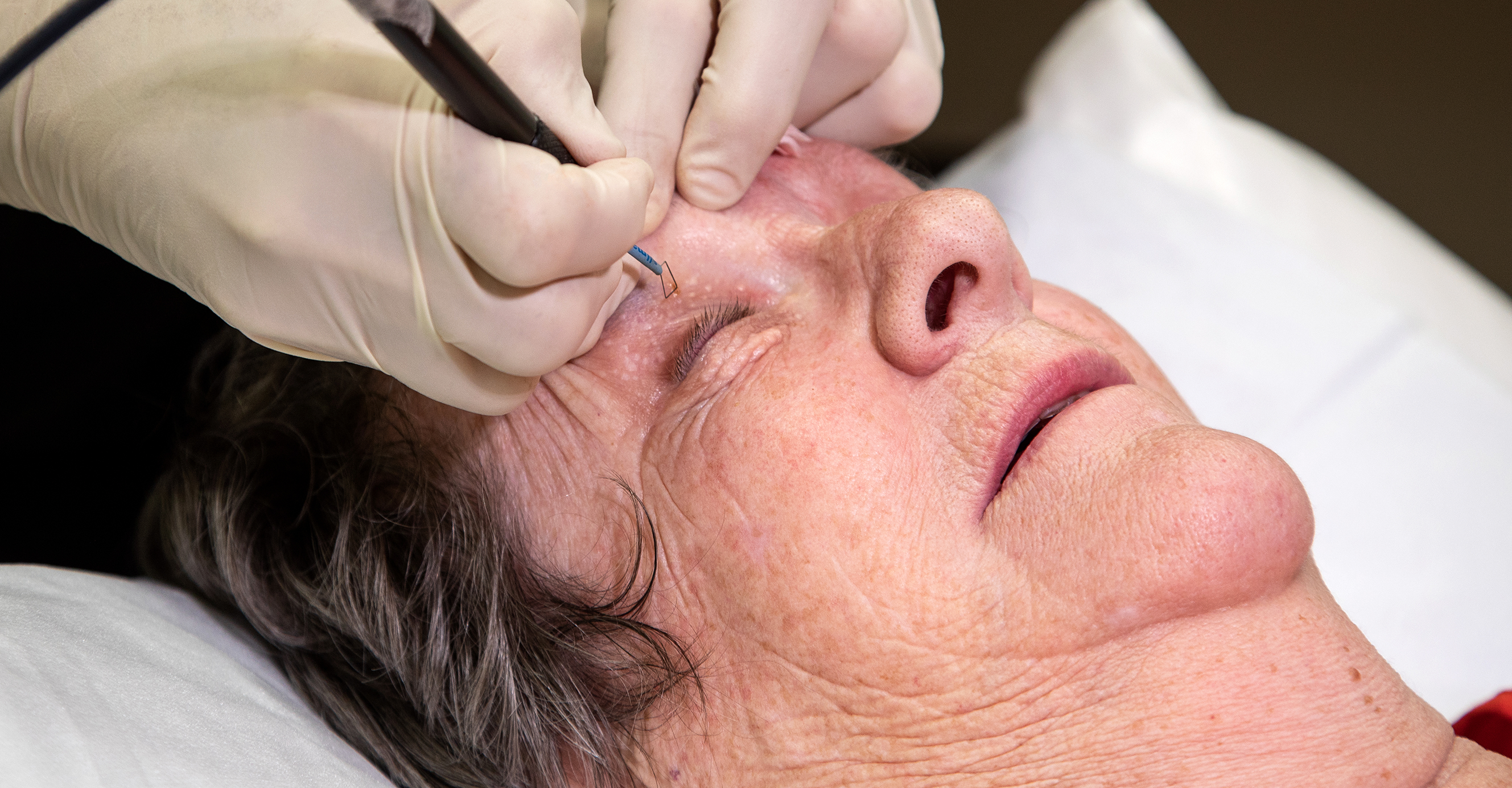 SURGITRON COSMETIC MOLE REMOVAL – Skin On Forty Five